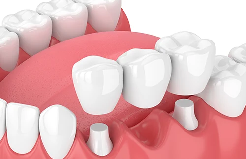 Dental Inlays and Onlays in Fresno, CA